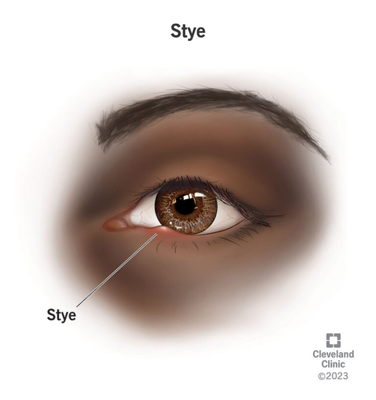 Stye | socialesarea